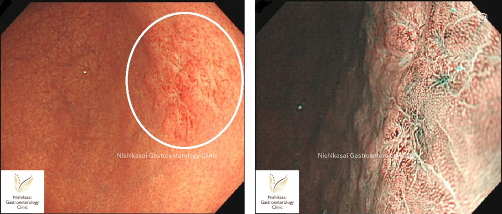 胃MALTリンパ腫 | 西葛西消化器内科クリニック｜江戸川区西葛西駅徒歩1分の内科・内視鏡検査・消化器内科｜胃カメラ・大腸カメラ検査